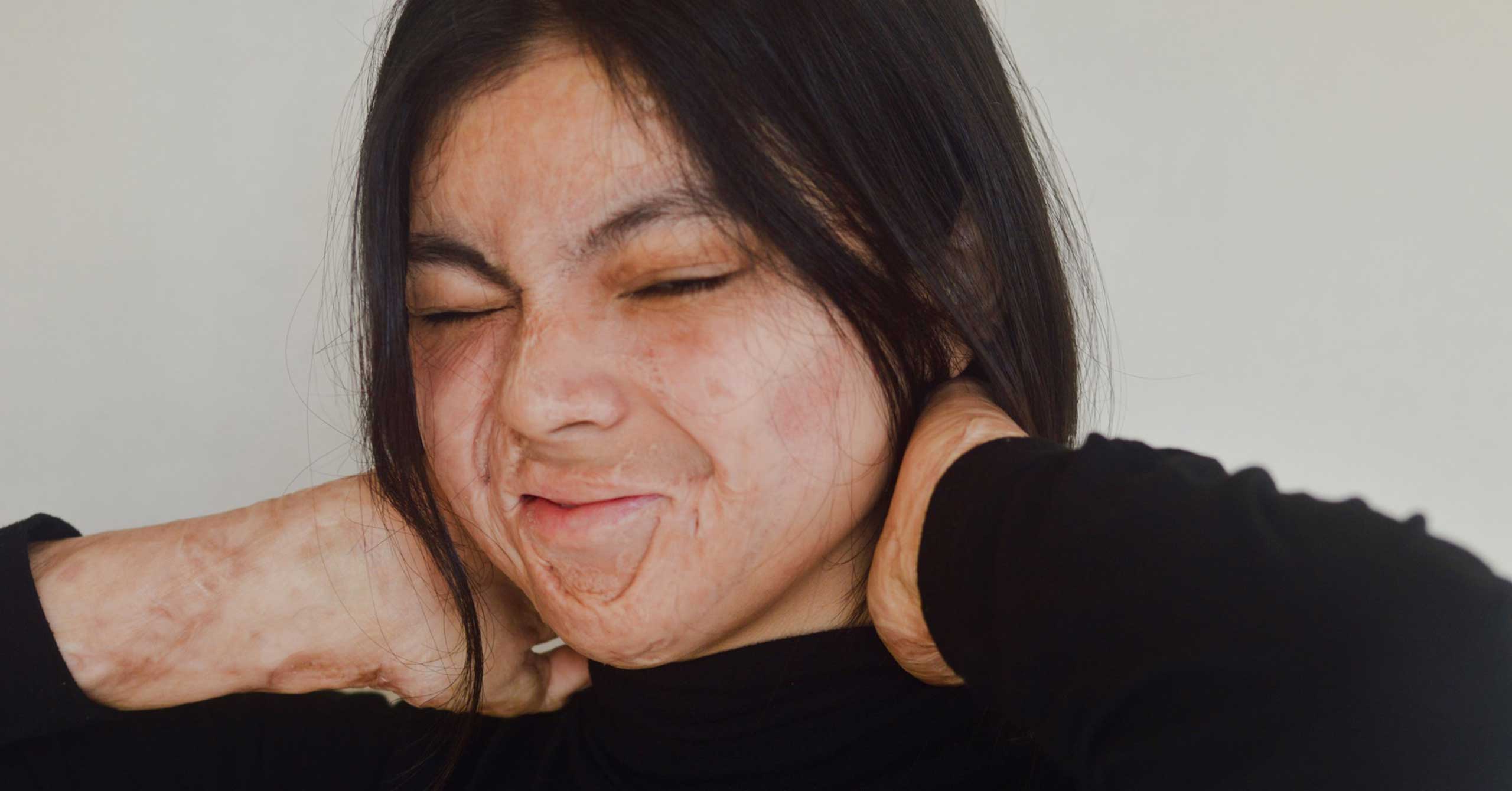 Burn Survivor Larra Lasam on Beauty Beyond Physical Features